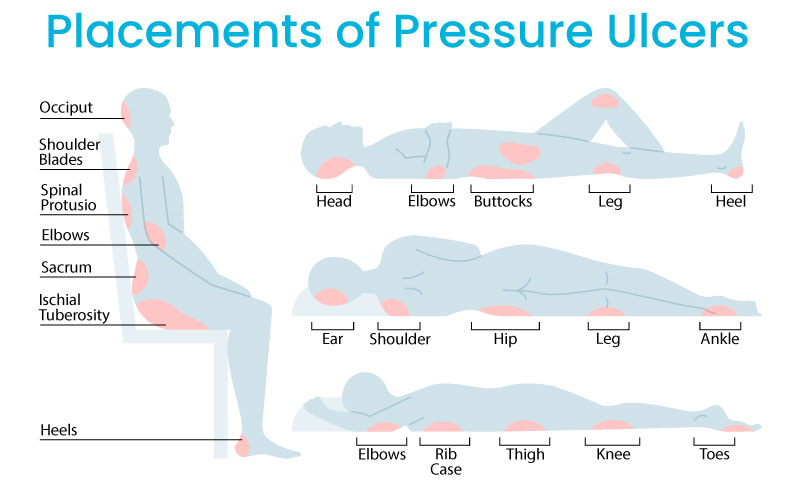 What Are Pressure Ulcers Identification Prevention An
